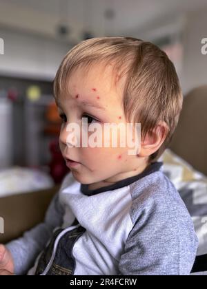 Jeune enfant avec la varicelle. Enfant malade avec la varicelle. Virus ...