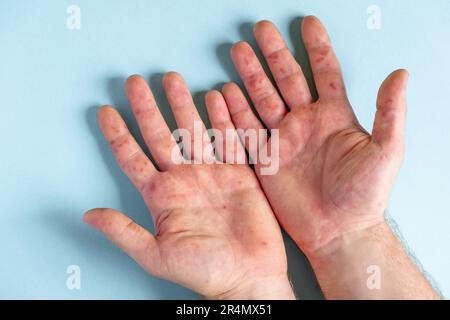 Éruption cutanée douloureuse, taches rouges cloques sur la main. Gros ...