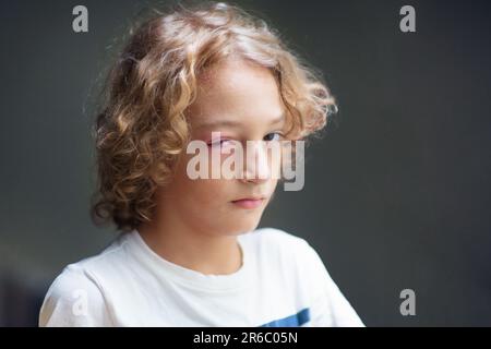 Enfant avec oeil rose gonflé. Infection des yeux et allergie au pollen ...