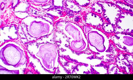 Histopathologie de l'hyperplasie de la prostate, micrographe léger ...