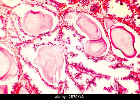 Hyperplasie de la prostate. Photomicrographe montrant les glandes ...