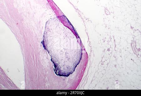 Calcification vasculaire, micrographe léger, coloration à l ...