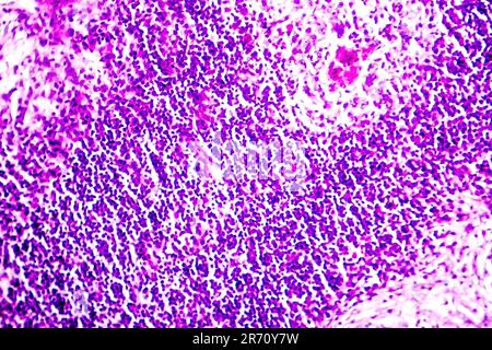 Nécrose caséeuse du nœud lymphatique, micrographe léger, photo sous ...