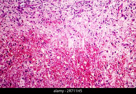 Infarctus splénique, micrographe léger, photo sous microscope Photo ...