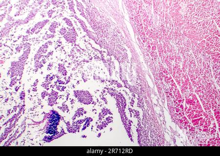 Histopathologie de la myocardite bactérienne, maladie cardiaque ...