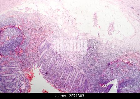 Histopathologie de l'appendicite chronique, micrographe léger, photo ...