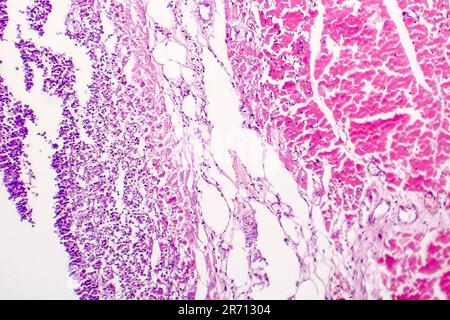 Histopathologie de la myocardite bactérienne, maladie cardiaque ...