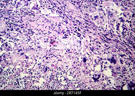 Histopathologie de la tuberculose, micrographe léger de la lésion de la ...