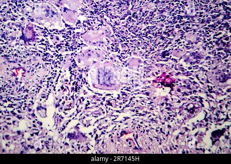 Histopathologie de la tuberculose, micrographe léger de la lésion de la ...