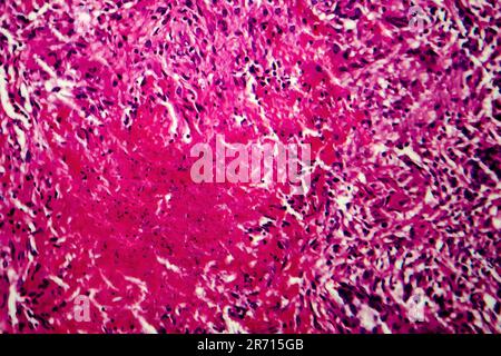 Tuberculose miliaire, micrographe léger, photo au microscope Photo ...