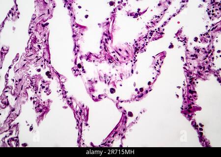 Histopathologie de l'emphysème pulmonaire, micrographe léger, photo ...