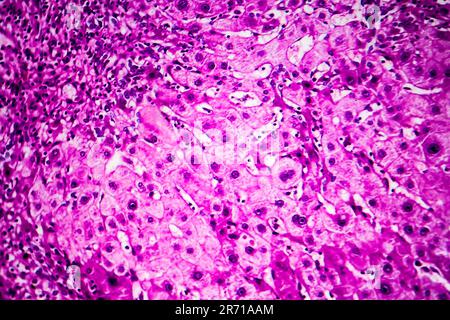 Histopathologie de la cirrhose du foie portale, micrographe léger ...