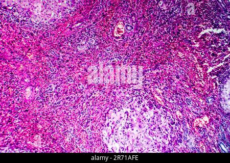 Histopathologie de la cirrhose du foie portale, micrographe léger ...