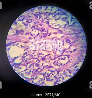 Carcinome folliculaire thyroïdien, micrographe léger, photo sous ...