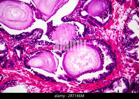 Hyperplasie bénigne de la prostate, micrographe léger, photo sous ...