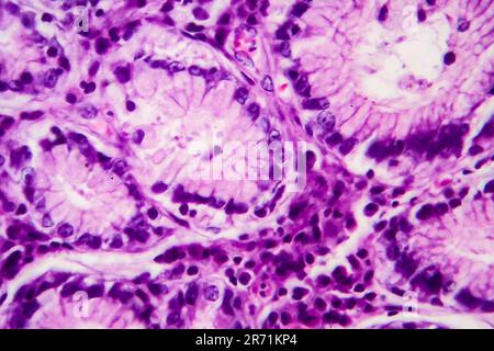 Histopathologie de l'adénocarcinome de l'estomac, micrographe léger ...