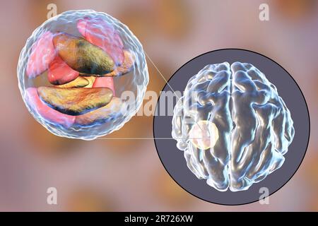 Neurotoxoplasmose, abcès cérébral causé par le protozoaire parasite ...