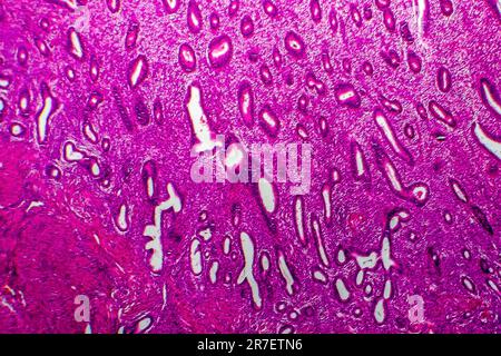 Hyperplasie de l'endomètre. Microphotographie lumière d'une section à ...