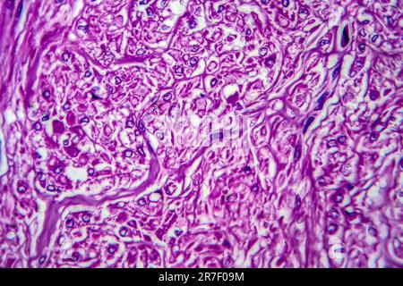 Les fibromes utérins. La lumière microphotographie (LM) d'une section à ...