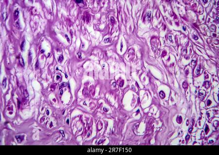 Les fibromes utérins. La lumière microphotographie (LM) d'une section à ...