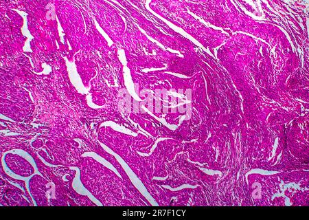 Cancer du col de l'utérus. La lumière microphotographie (LM) d'une ...