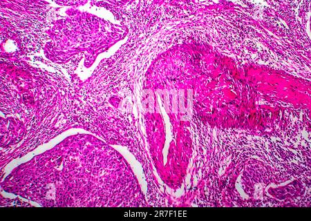 La microscopie optique de carcinome de la peau. La microscopie optique de carcinome de la peau ...
