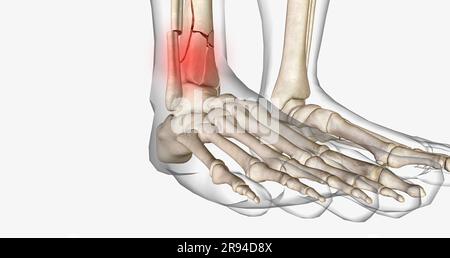 Les fractures du tibia distal affectent l'articulation de la cheville ...