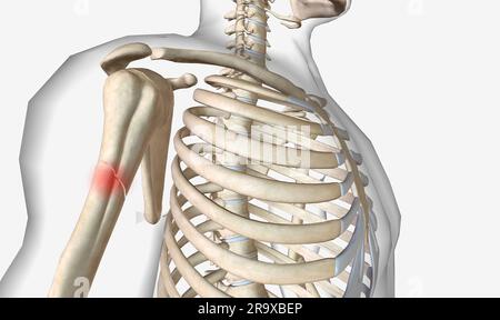 Une fracture, appelée rupture d'os , est une blessure aiguë qui ...