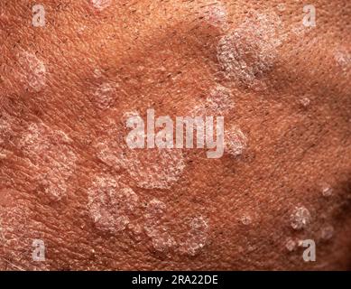 Le tinea capitis. Close-up of a la teigne lésion sur le cuir chevelu ...