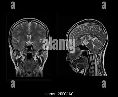 IRM du cerveau Comparer les plans coronaire et sagittal pour détecter ...