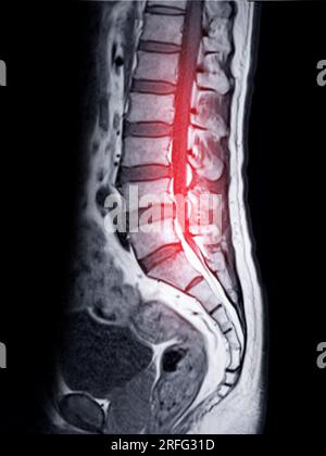 IRM rachis L-S ou rachis lombaire Sagittall T1W, T2 FS et T2W vue pour ...