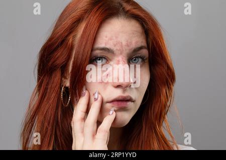 Jeune femme avec une éruption cutanée aiguë sur son visage. Problèmes ...