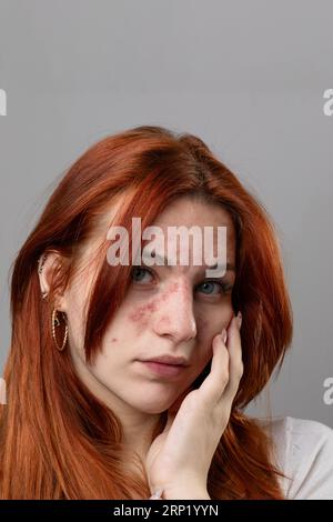 Jeune femme avec une éruption cutanée aiguë sur son visage. Problèmes ...