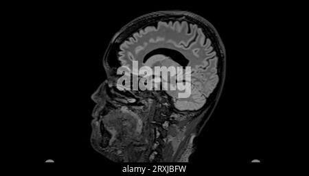 Flair sagittal d'IRM du cerveau pour détecter les maladies du cerveau ...