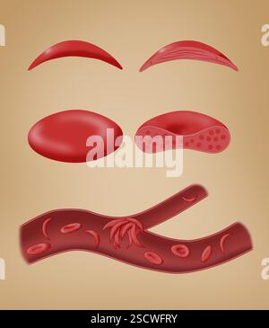 La drépanocytose est une maladie génétique récessive. Illustration ...