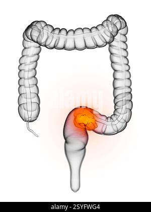 Rectum ou cancer colorectal avec des organes et des cellules ...
