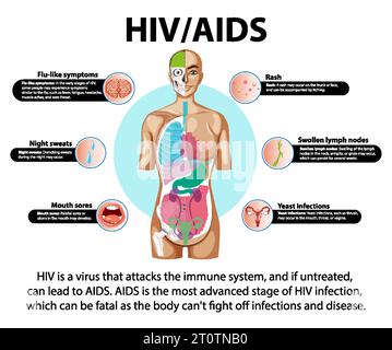 Illustration illustrant comment le virus du VIH/sida attaque le système ...