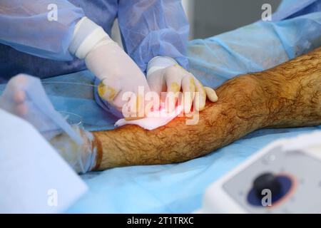 Chirurgie médicale de la photocoagulation endoveineuse au laser de la ...