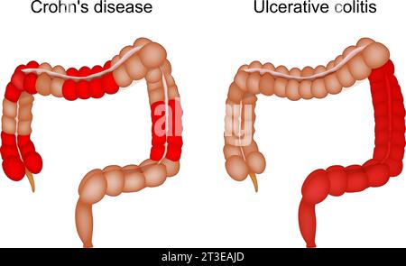 Colite ulcéreuse. Maladie inflammatoire intestinale MICI. Gros et petit ...