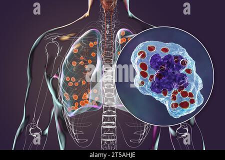 Histoplasmose pulmonaire, illustration Photo Stock - Alamy