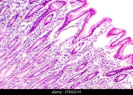 Photomicrographie des métaplasies intestinales, montrant la ...