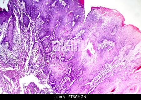 Photomicrographie d'un carcinome épidermoïde cutané, représentant des cellules épidermiques ...
