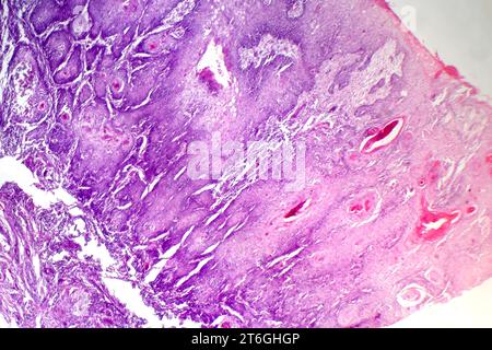 Photomicrographie d'un carcinome épidermoïde cutané, représentant des cellules épidermiques ...