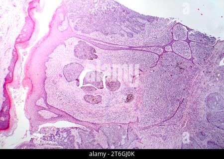 Photomicrographie du carcinome basocellulaire, montrant les cellules basales malignes typiques ...