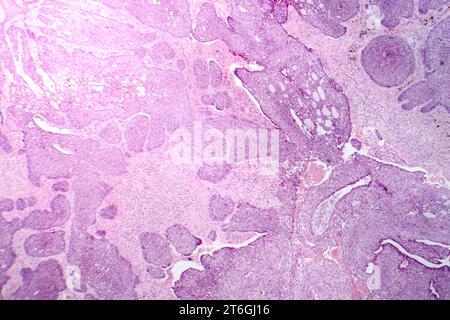 Photomicrographie du carcinome basocellulaire, montrant les cellules basales malignes typiques ...