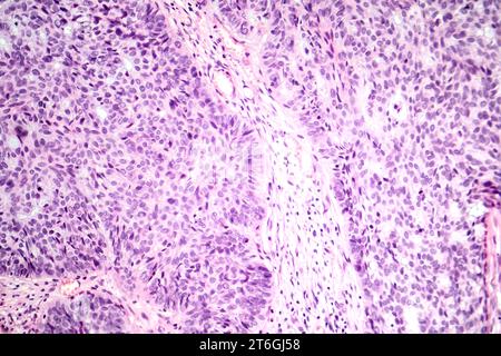 Photomicrographie du carcinome basocellulaire, montrant les cellules basales malignes typiques ...
