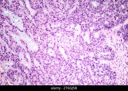 Photomicrographie du carcinome basocellulaire, montrant les cellules ...