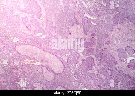 Photomicrographie du carcinome basocellulaire, montrant les cellules basales malignes typiques ...