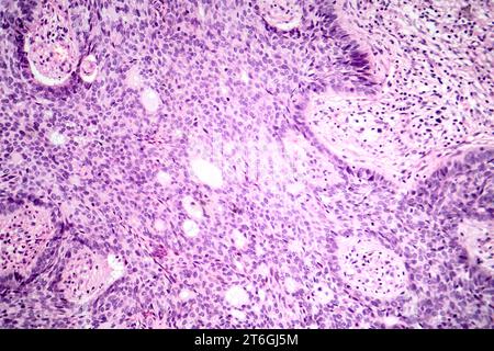 Photomicrographie du carcinome basocellulaire, montrant les cellules basales malignes typiques ...