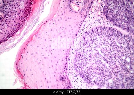 Photomicrographie du carcinome basocellulaire, montrant les cellules basales malignes typiques ...